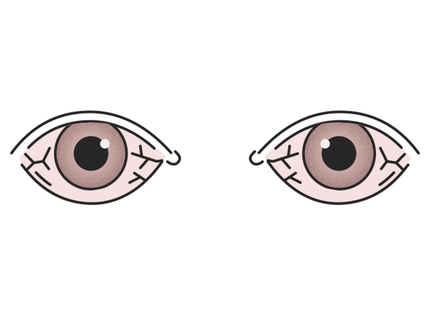 What is conjunctivitis (pink eye)? | Vision Express