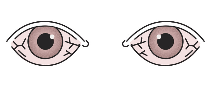 Red eyes and their causes, symptoms and treatment | Vision Express