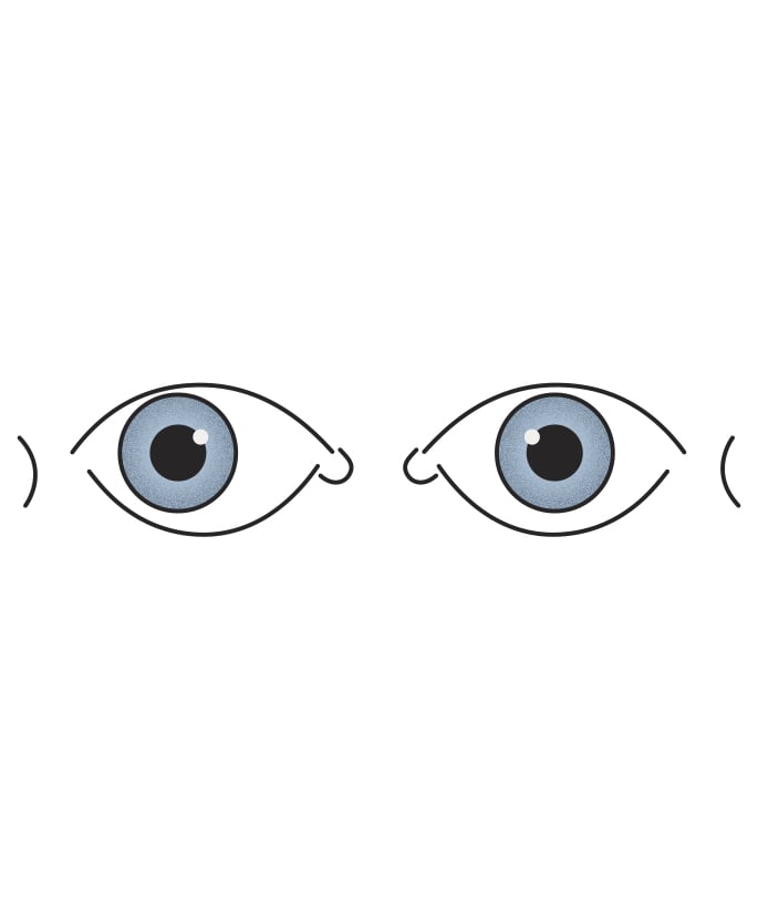 Strabismus (squint/cross eyed) causes and symptoms | Vision Express