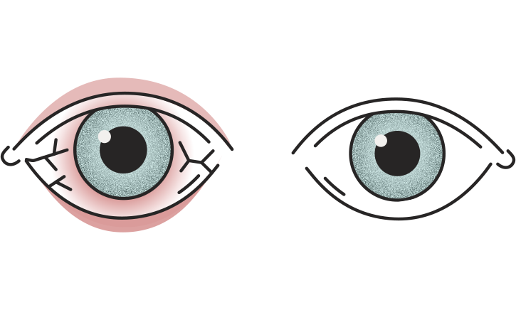 Causas e Tratamento da Irite | MultiOpticas