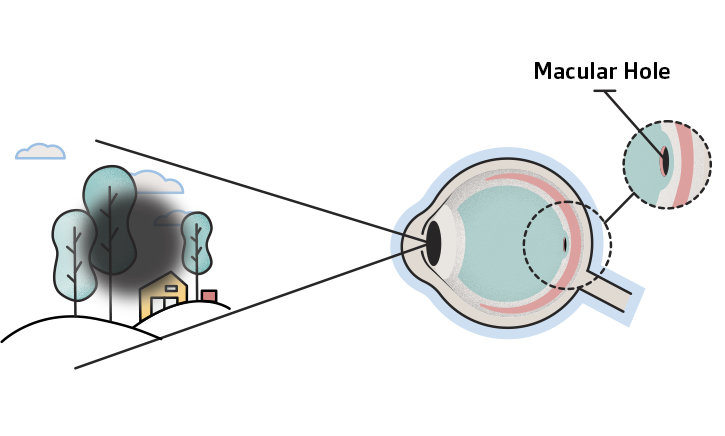 Buraco Macular | Sintomas, Causas e Tratamentos | MultiOpticas