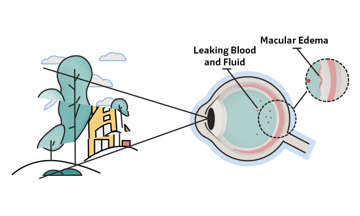 Edema macular | Tratamento | MultiOpticas